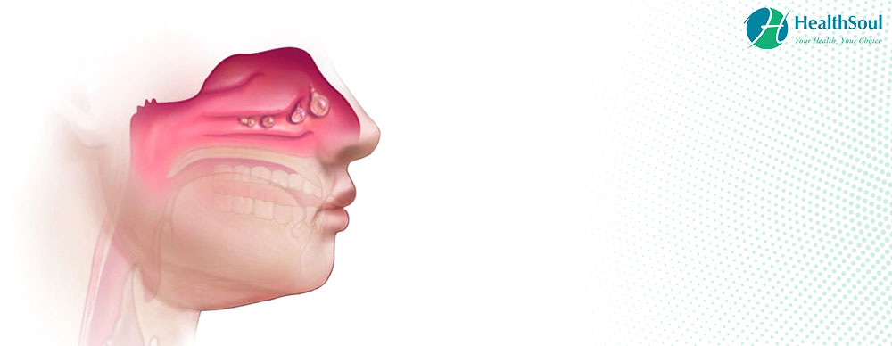 Nelsons Syndrome