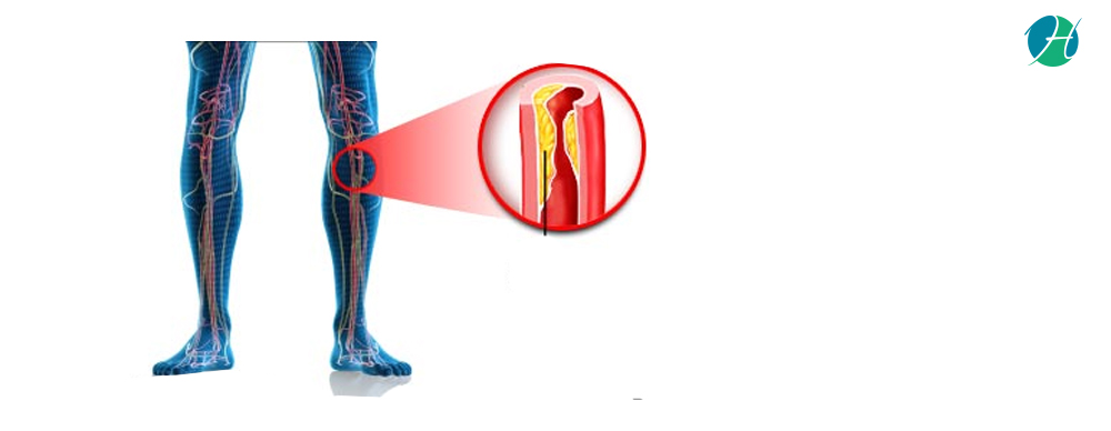 Claudication: Symptoms and Treatment | Vascular Surgery | HealthSoul