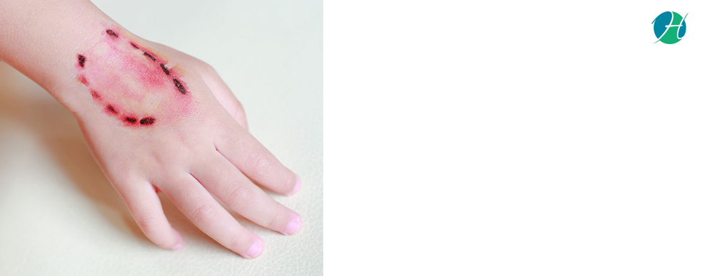 Rabies: Symptoms and Treatment | Infectious Disease | HealthSoul