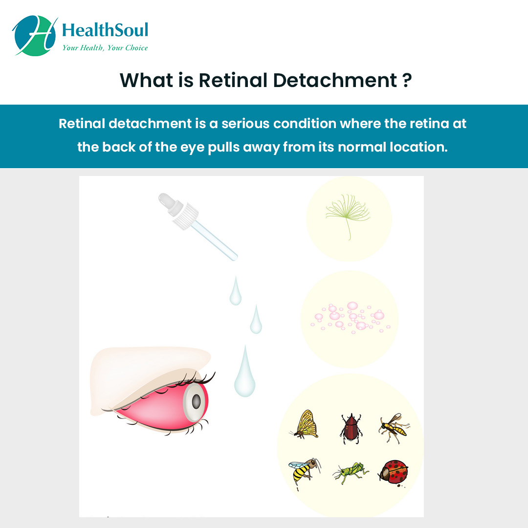 Retinal Detachment: Symptoms, Diagnosis and Treatment – Healthsoul