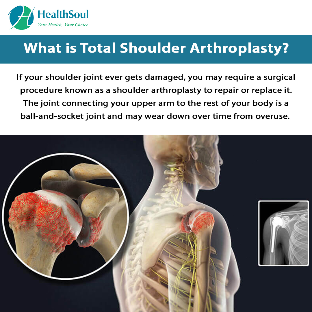 Total Shoulder Arthroplasty Learn About The Procedure Healthsoul