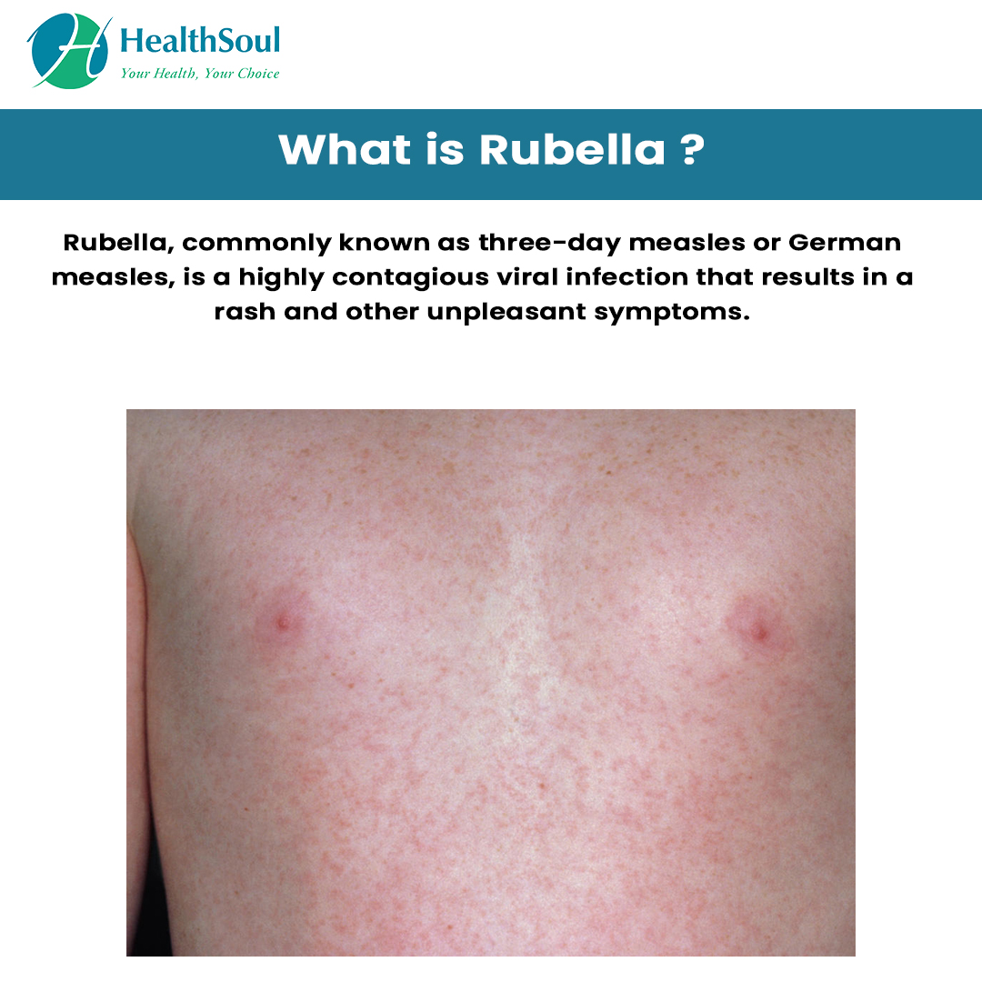 Rubella Symptoms And Treatment Infectious Disease HealthSoul