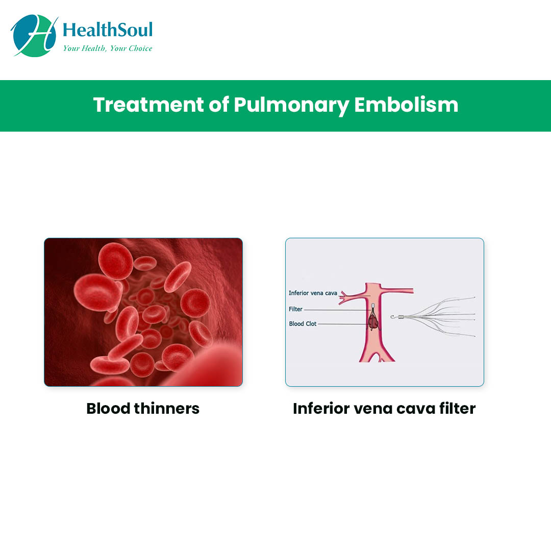 Pulmonary Embolism: Causes, Symptoms and Treatment – Healthsoul
