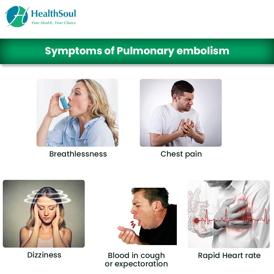 Pulmonary Embolism