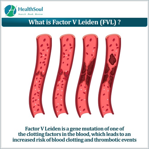 Factor V Leiden Symptoms Causes And Treatment Healthsoul