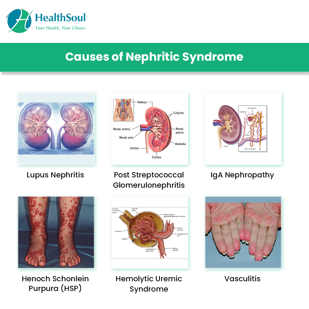 Nephritic Syndrome Symptoms And Treatment Healthsoul Nephritic Syndrome Symptoms And Treatment Healthsoul