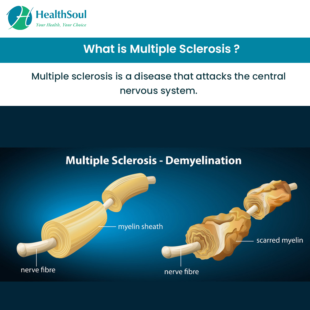 Multiple Sclerosis Symptoms Diagnosis And Treatment Healthsoul