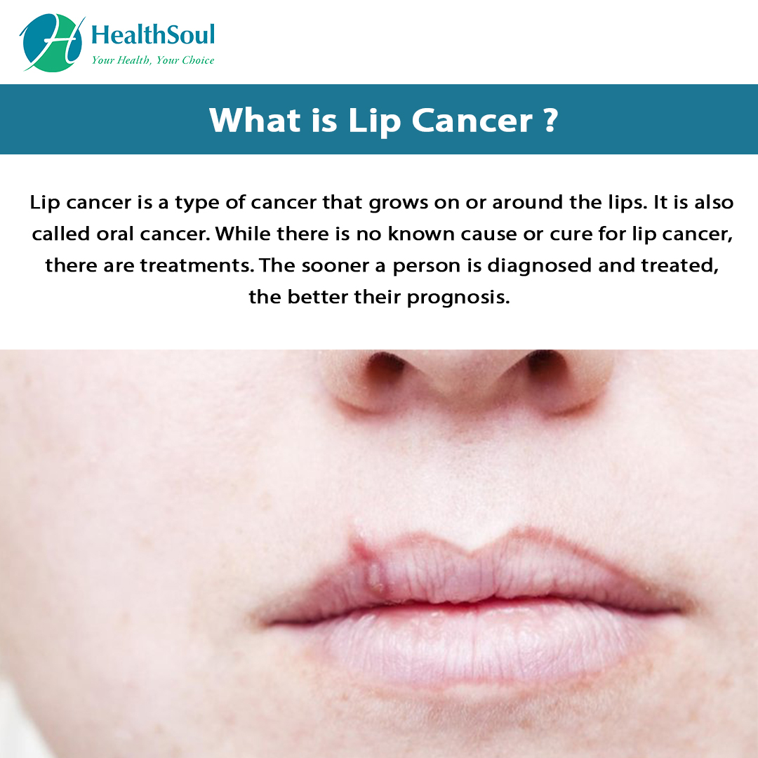 Lip Cancer Treatment CancerWalls